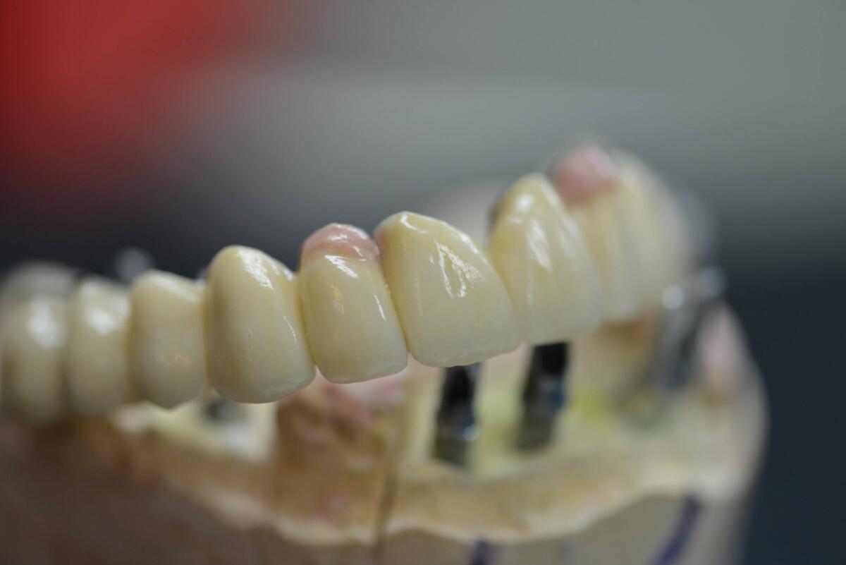 Cazuri clinice - Abutment Implants